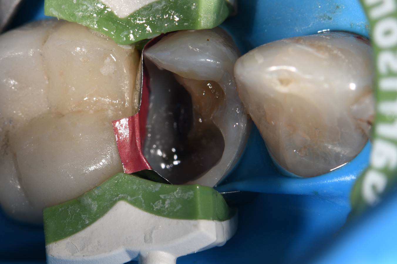 Ormocer base for a complex composite restoration