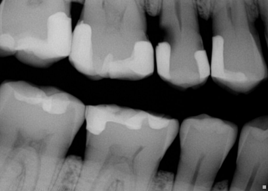 Deep complex cavities restored biomimetically