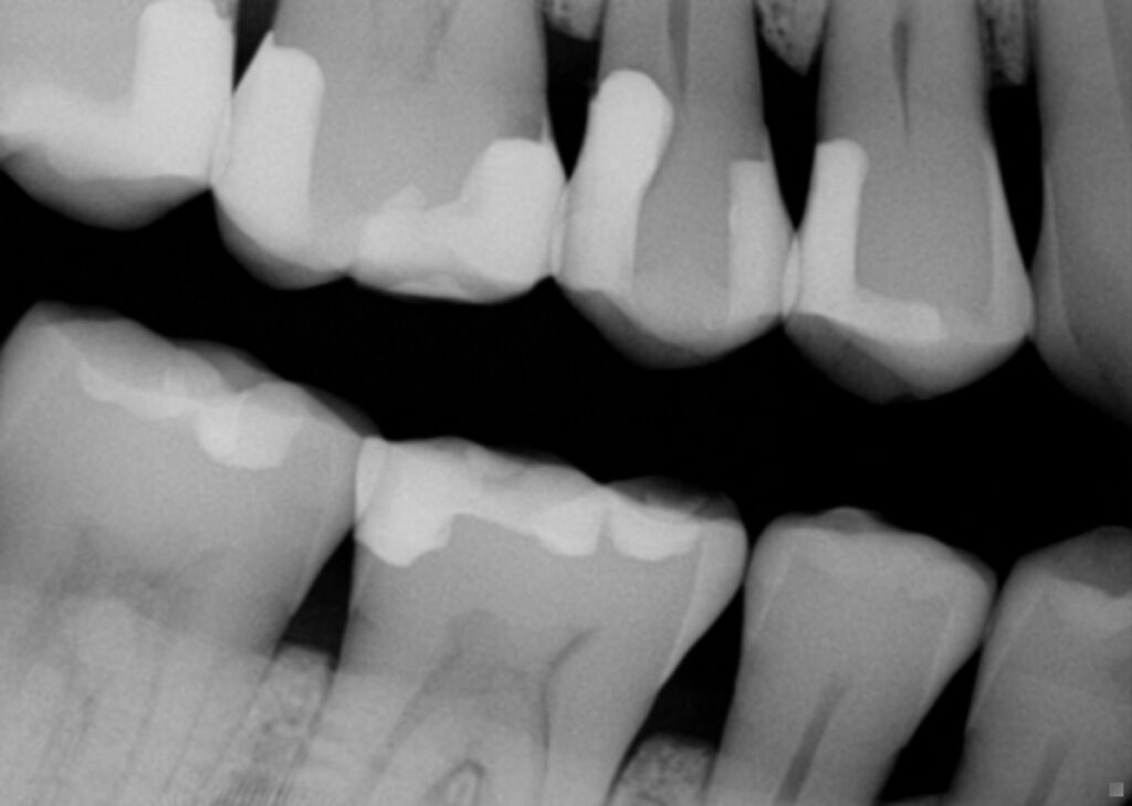 Deep complex cavities restored biomimetically