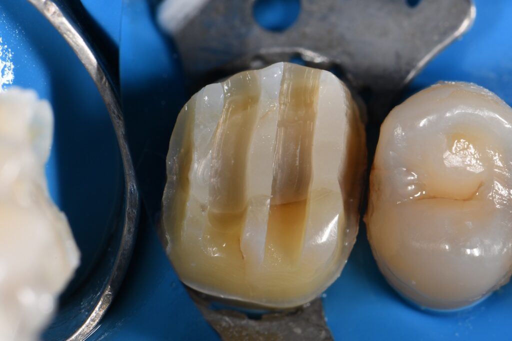 Minimal preparation porcelain crowns