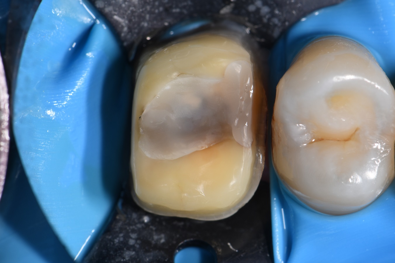 Minimal preparation porcelain crowns