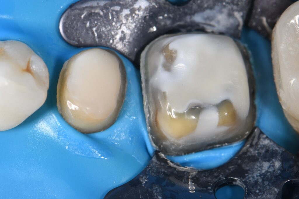 Bonded Crown workflow