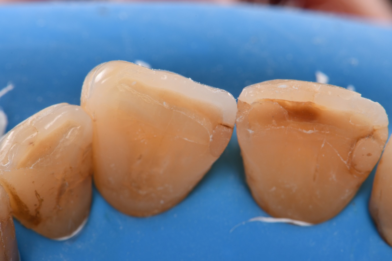 Cloud Shaded Composites and Shade Precision in matching