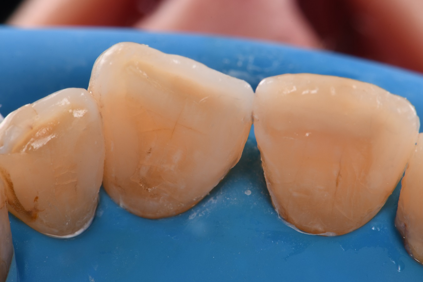 Cloud Shaded Composites and Shade Precision in matching