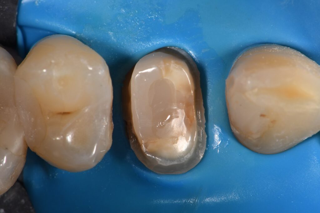 Dental Crown over Root Canaled Tooth