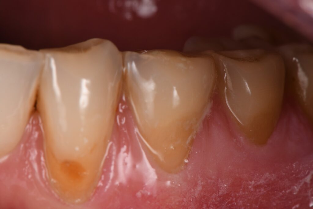 Ormocer composites suitable for use in cervical abfraction cases