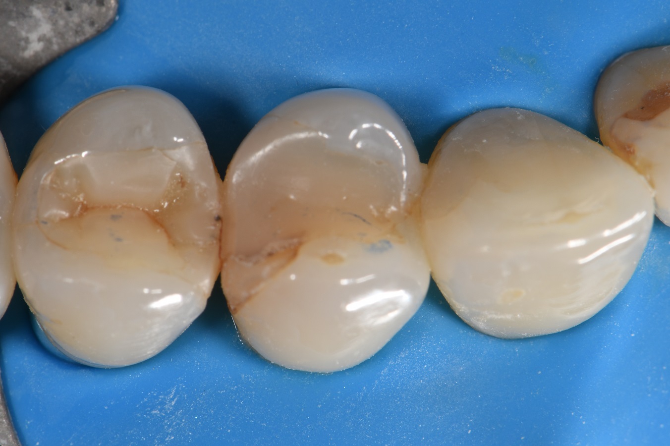 Restoring Large Dental Caries