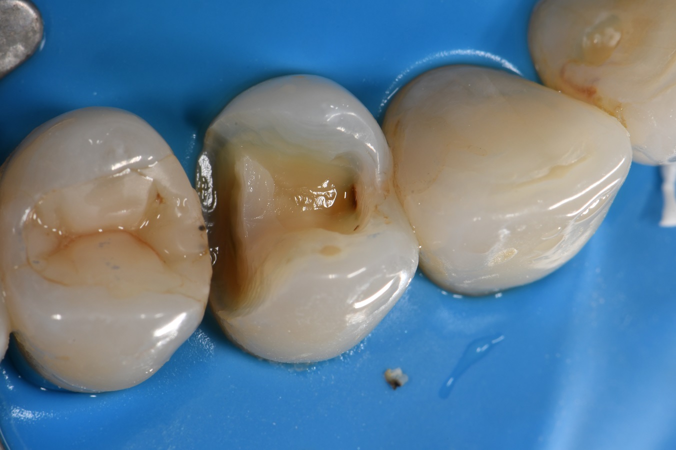 Restoring Large Dental Caries