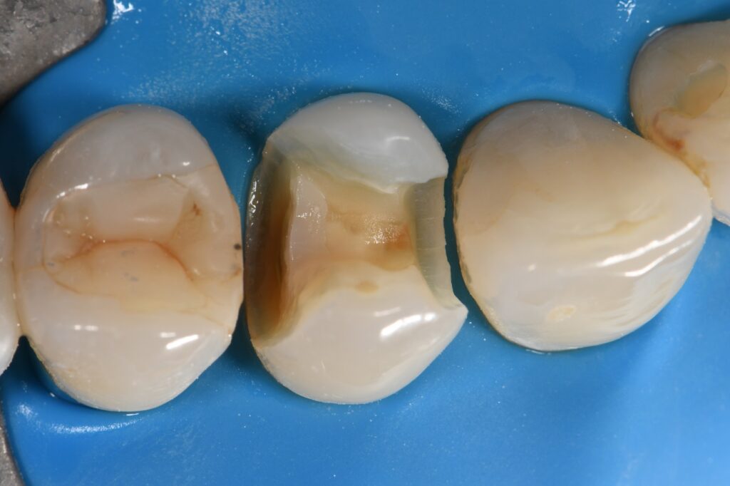 Restoring Large Dental Caries