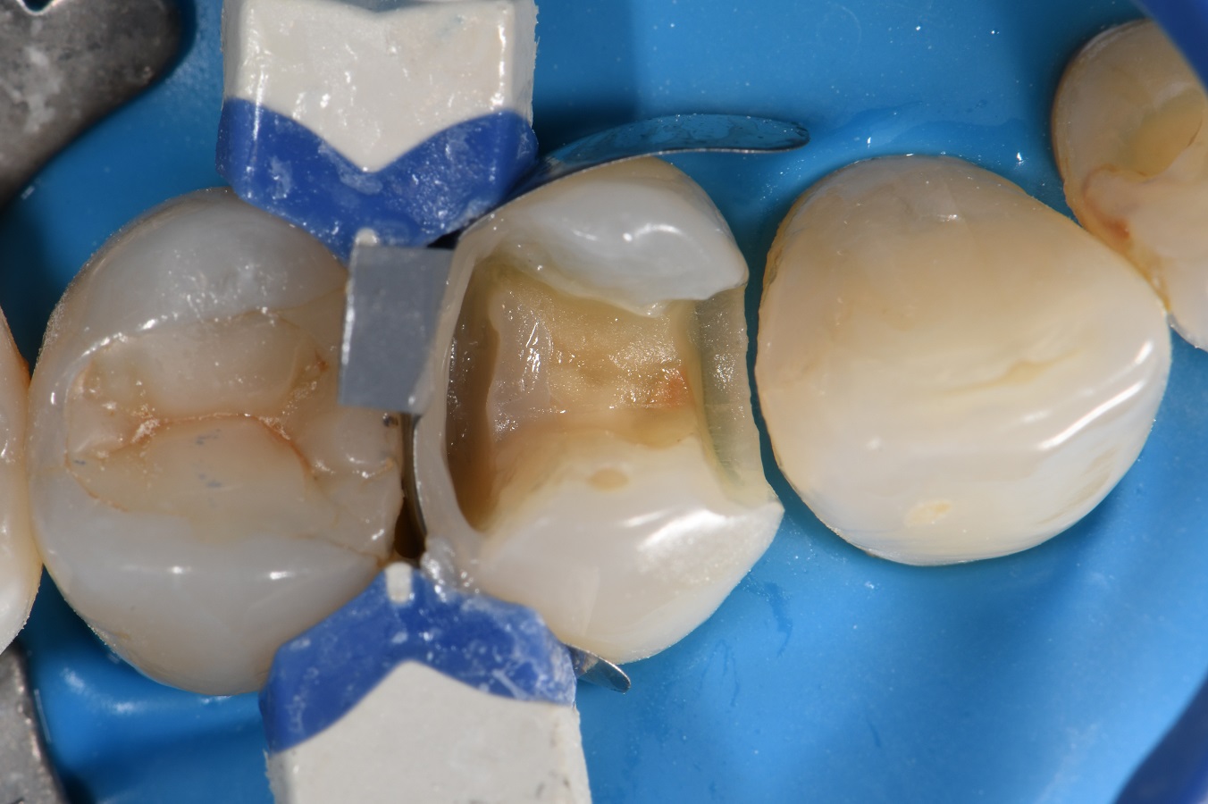 Restoring Large Dental Caries