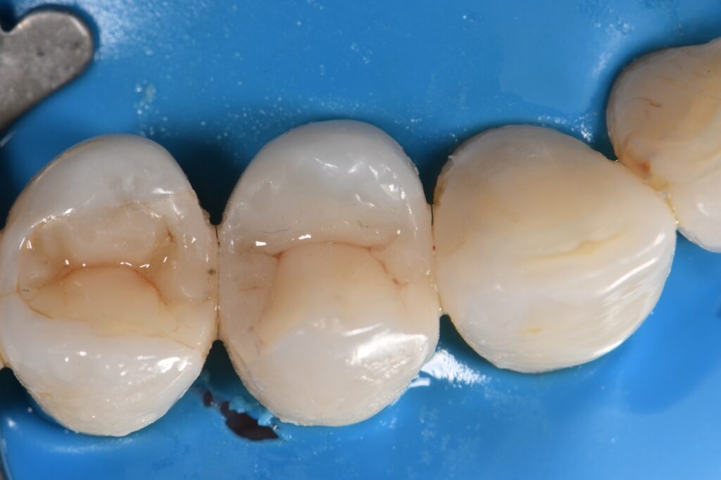 Restoring Large Dental Caries