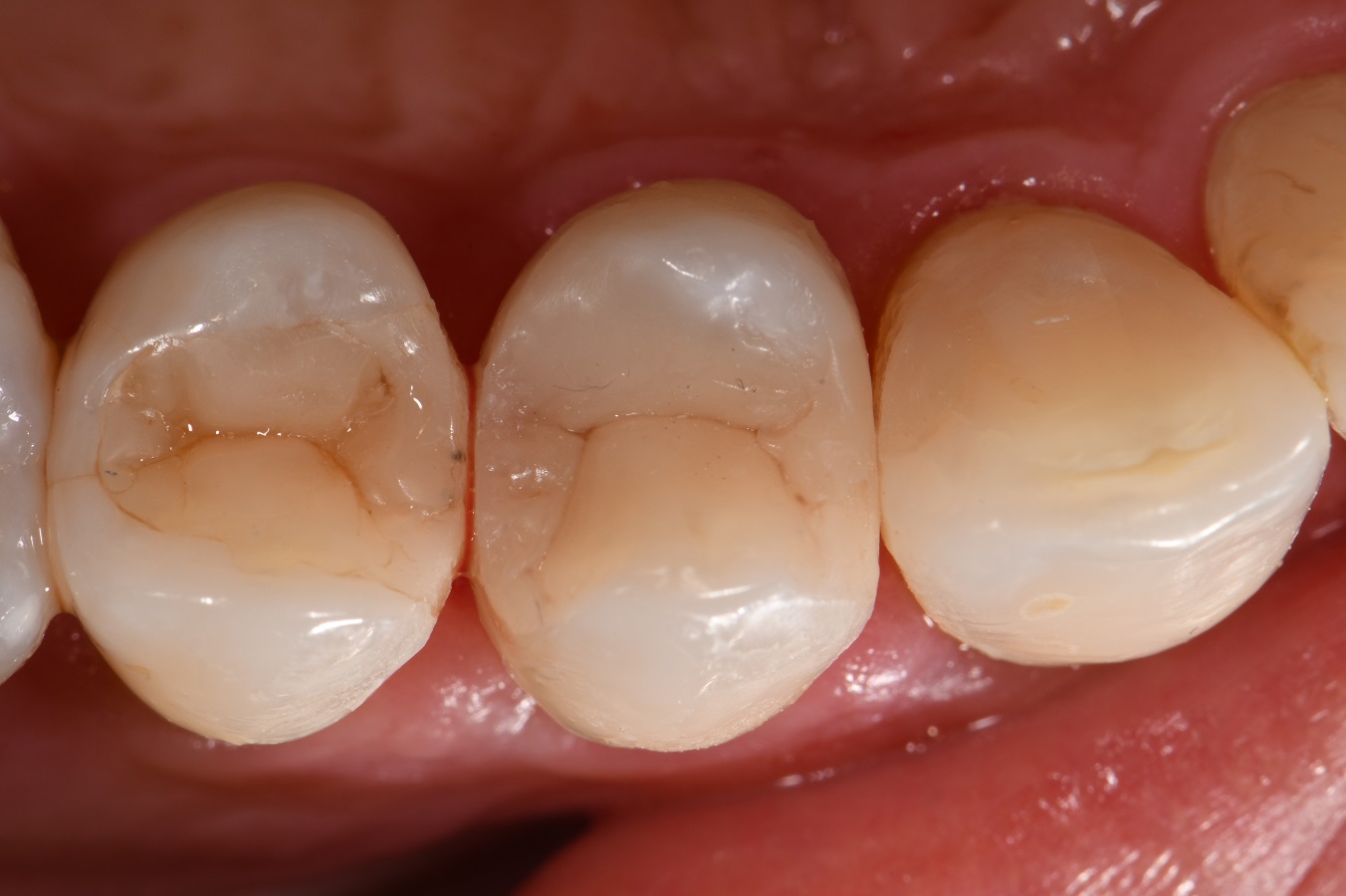 Restoring Large Dental Caries