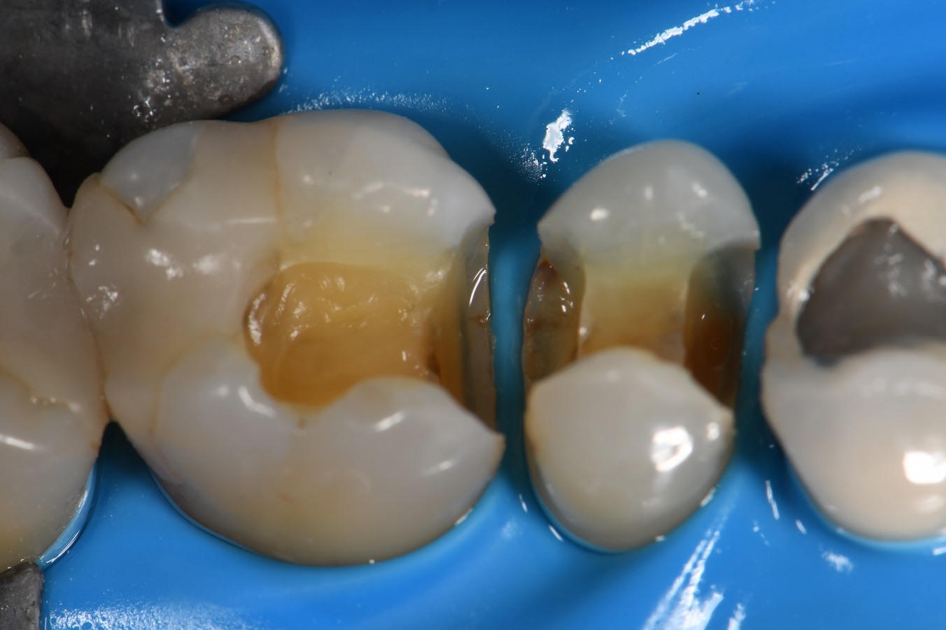 Replacing Part of an old Dental Composite Restoration