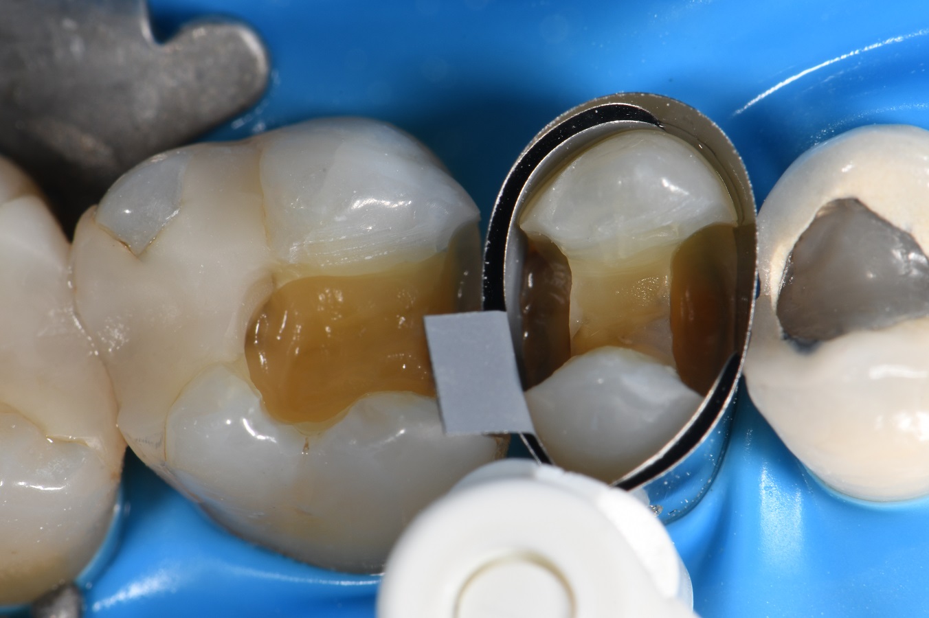 Replacing Part of an old Dental Composite Restoration