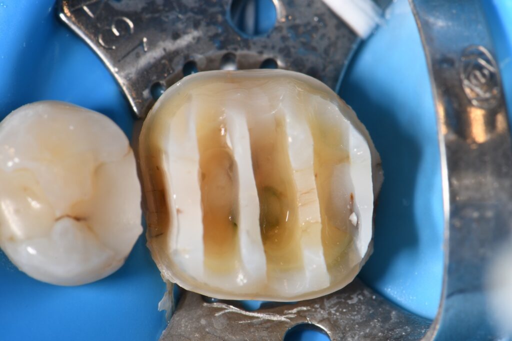 Conservative Full Coverage Indirect Restorations