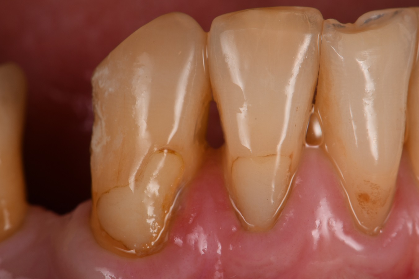 Extreme Class V cervical abrasion lesions