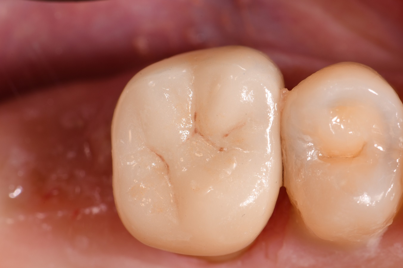 Minimal preparation porcelain crowns