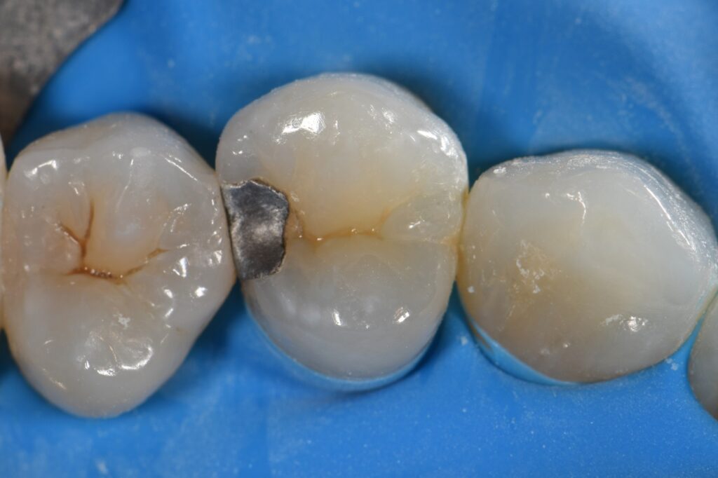 Matching Fissure Styles in Composite Restorations