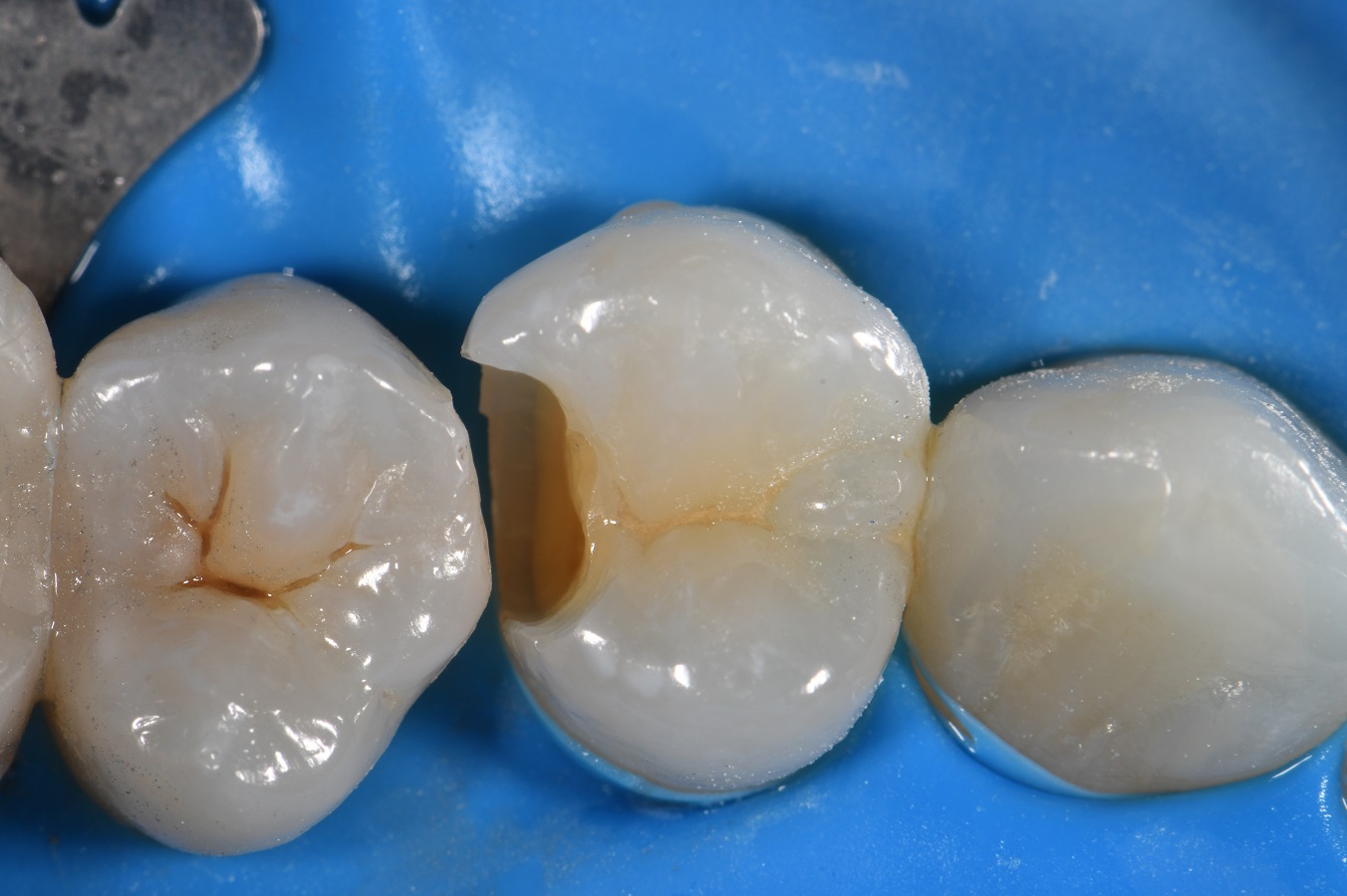 Matching Fissure Styles in Composite Restorations