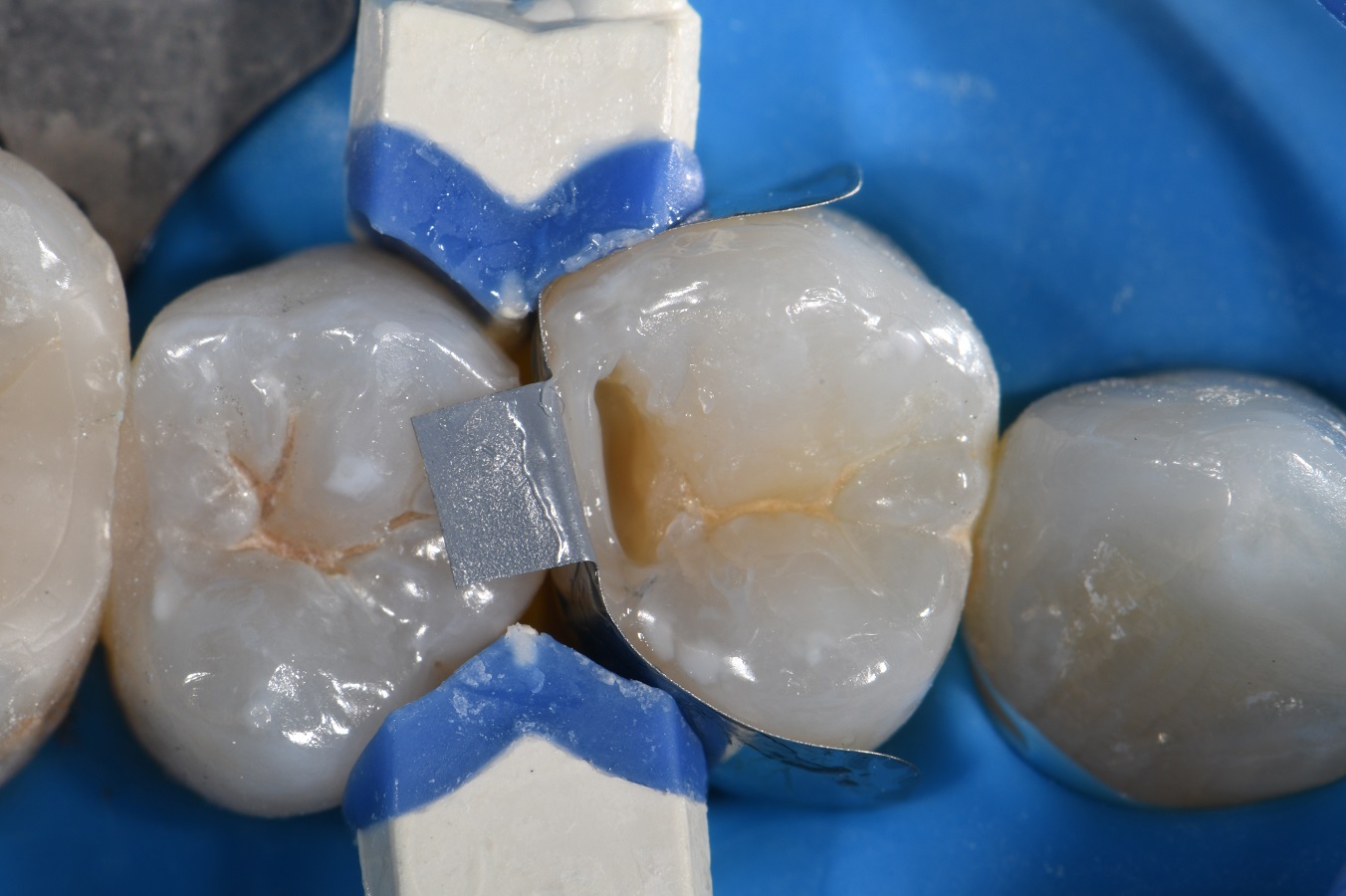Matching Fissure Styles in Composite Restorations