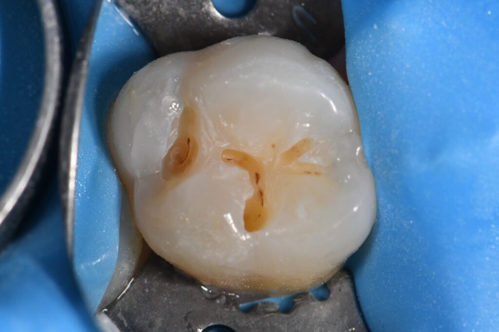 Microlayered Composite Restoration