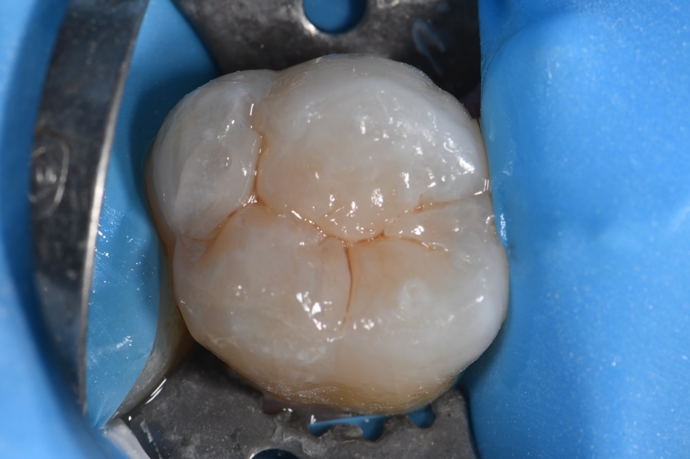 Microlayered Composite Restoration