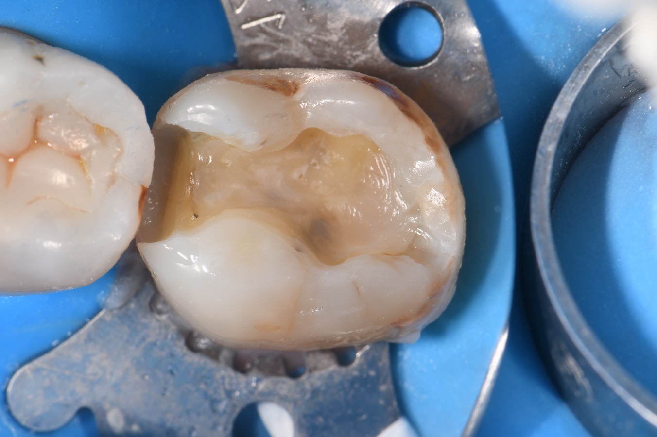 Voco Grandio SO Partial Replacement Therapy