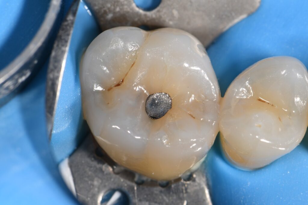 Conservative Composite Restorations