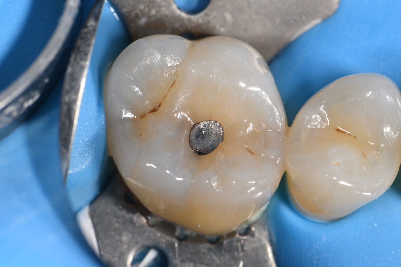 Conservative Composite Restorations