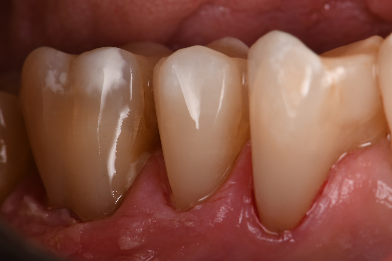 Root caries is a consideration with exposed radicular dentin