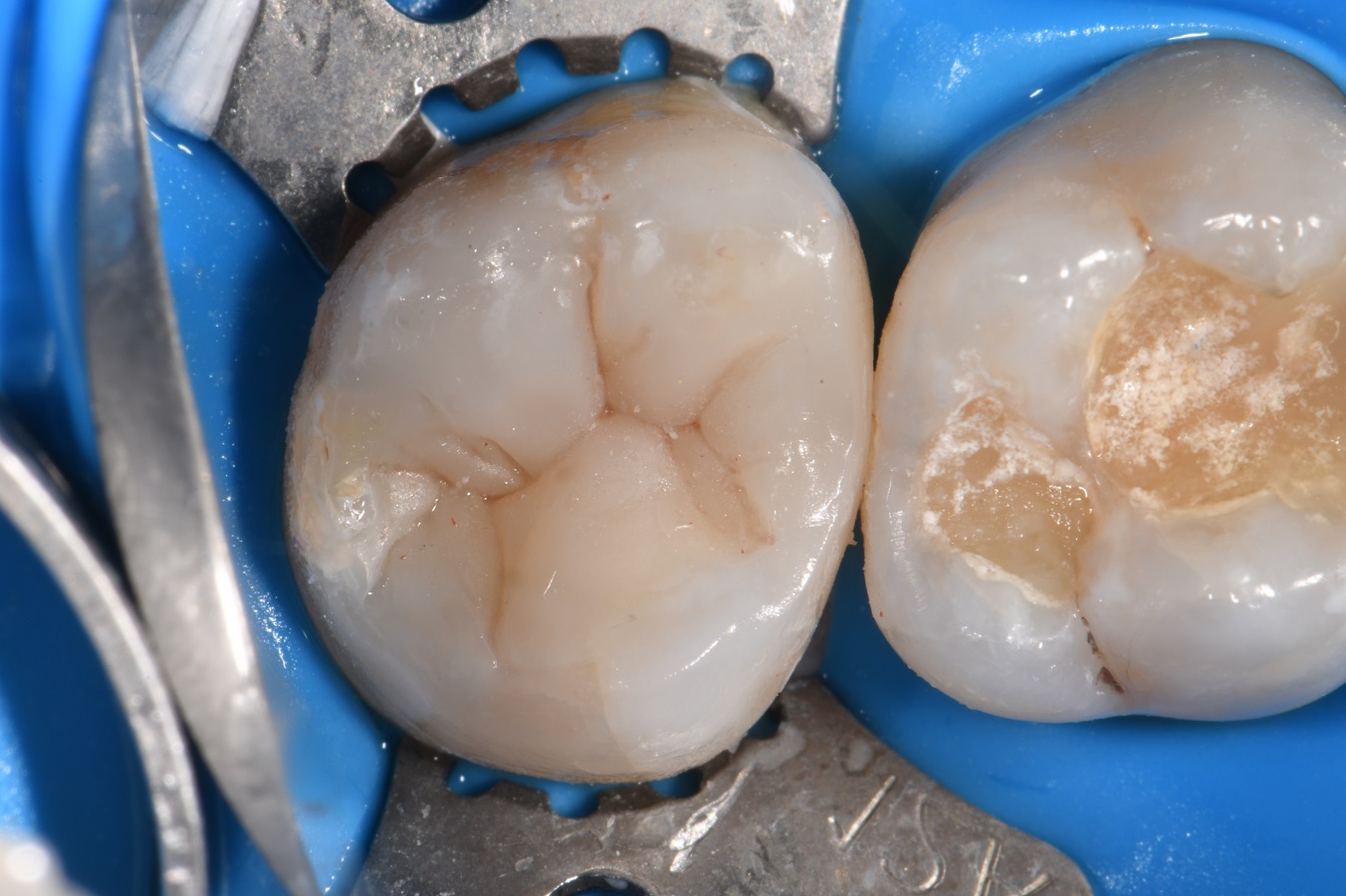 Supercomposite Predictability in Direct Dental Restorations