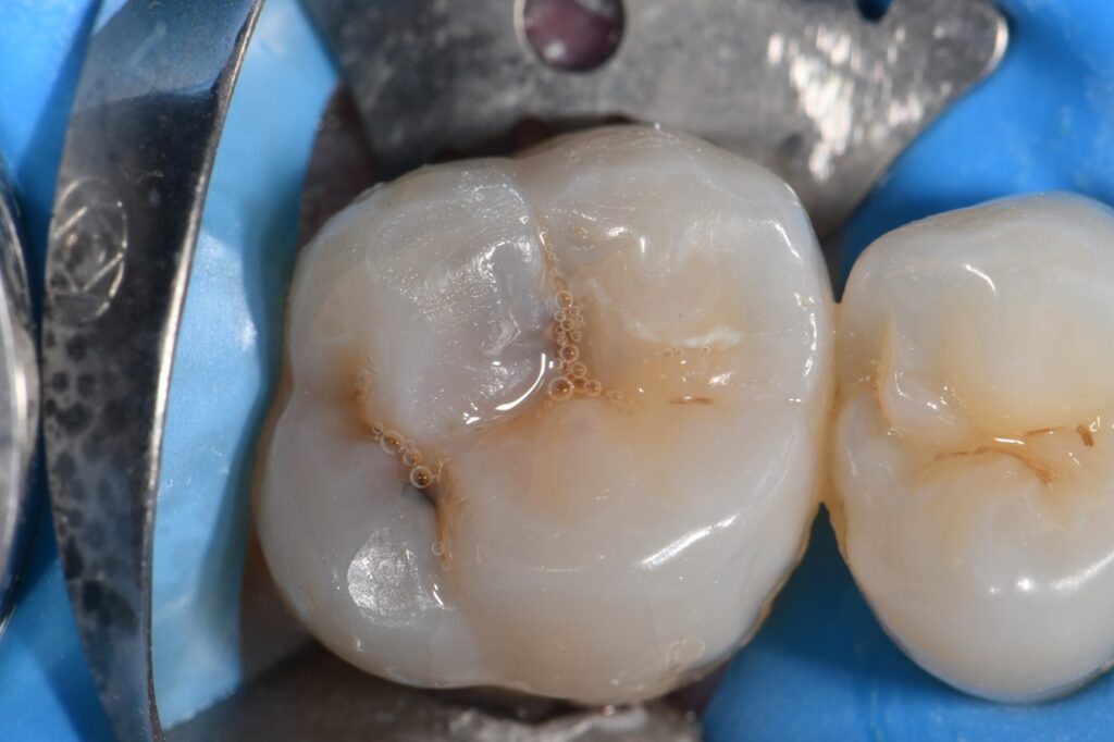 Kerr Simplishade Class I composite