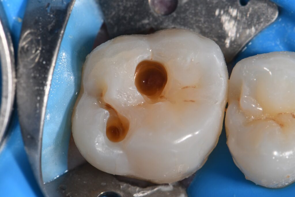 Kerr Simplishade Class I composite