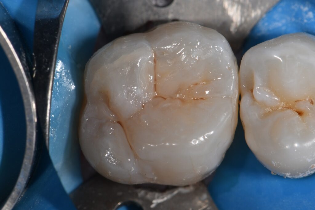 Kerr Simplishade Class I composite