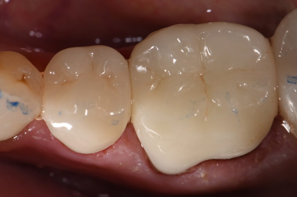 Bonded Crown workflow