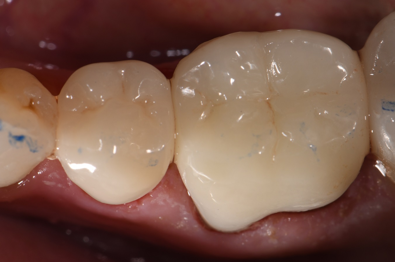Bonded Crown workflow