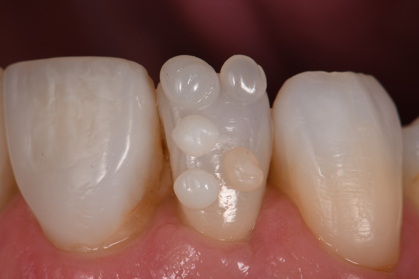 Composite Veneer to Change Shape of Lateral Incisor