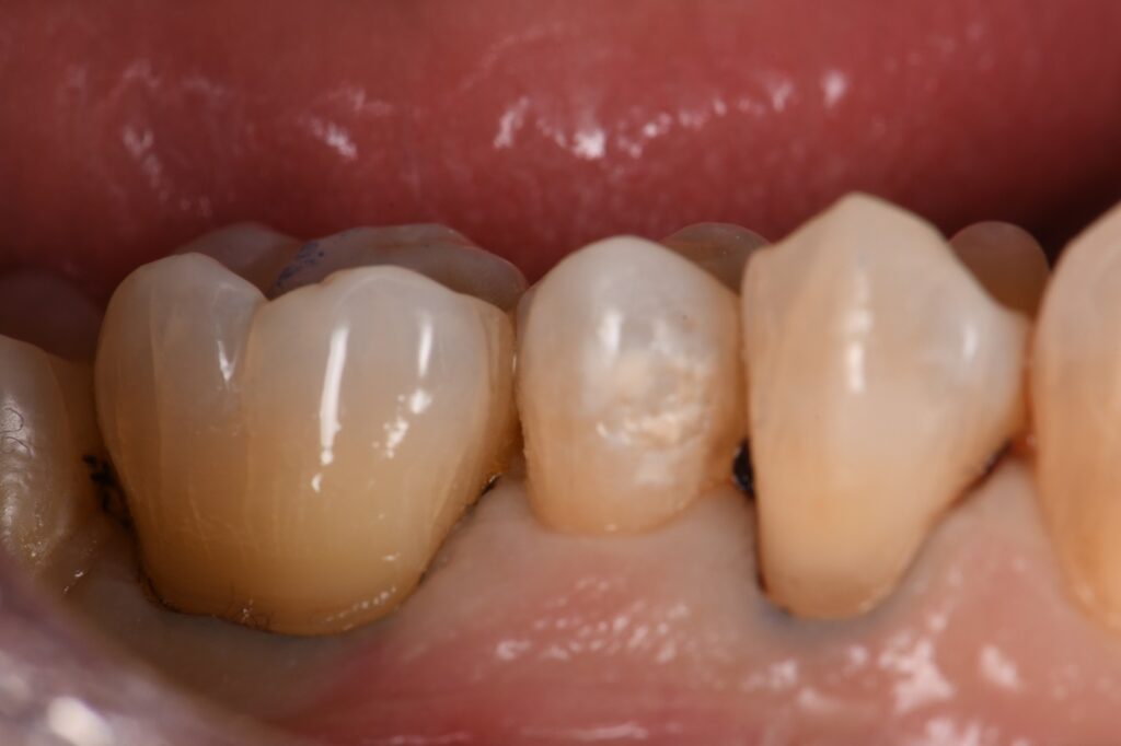 Class V lesions restored conservatively