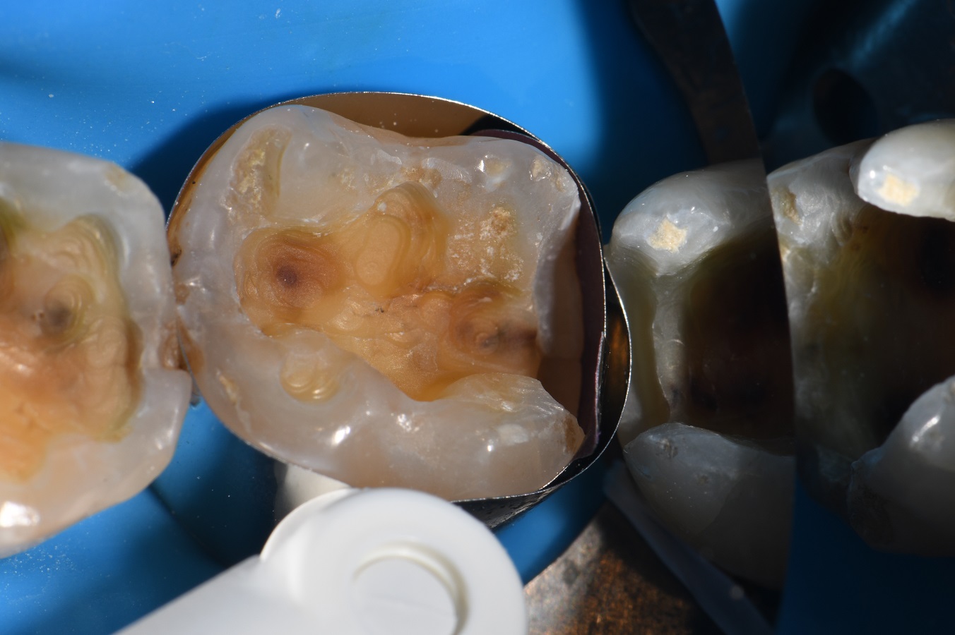 Reconstructing Cracked Teeth with Direct Composite