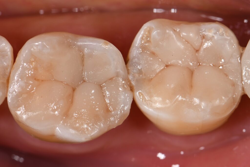 Reconstructing Cracked Teeth with Direct Composite