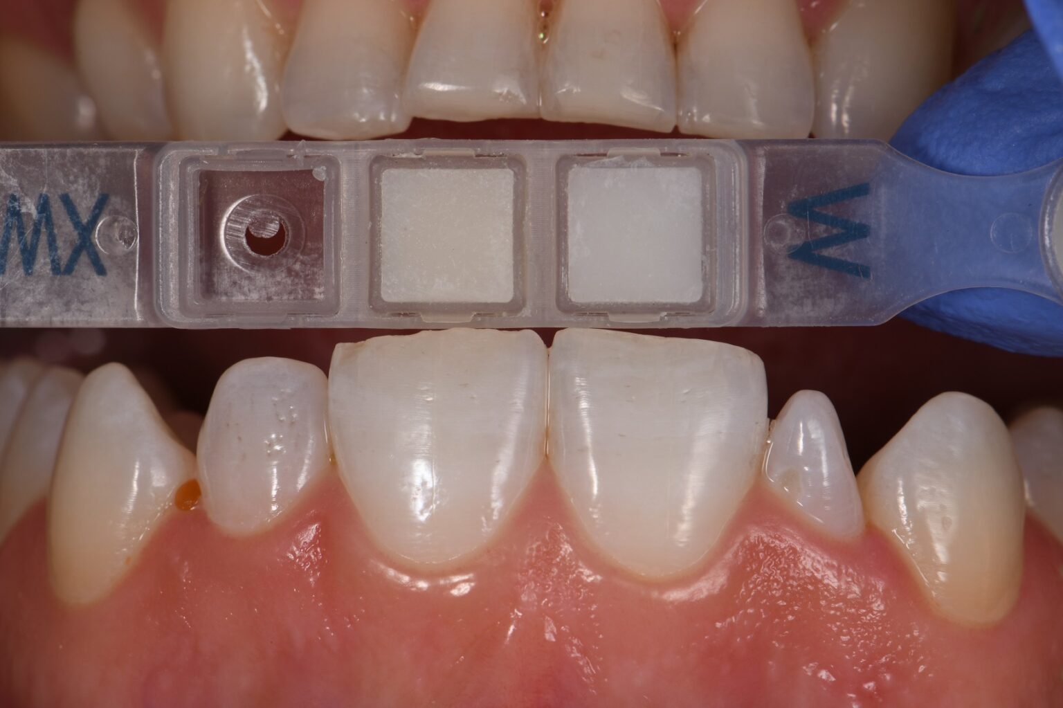 Composite Veneers and Gum Recontouring