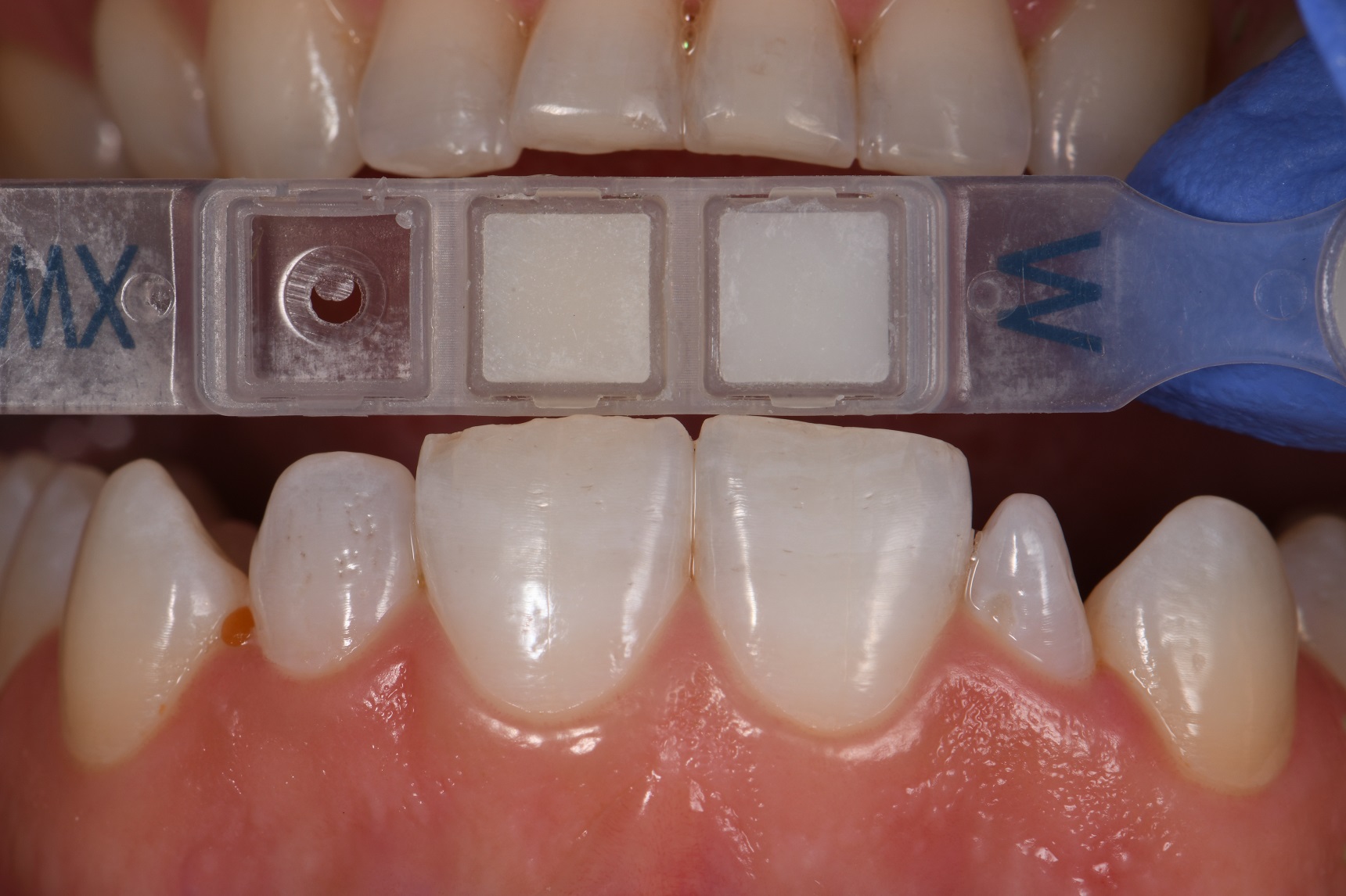Composite Veneers and Gum Recontouring