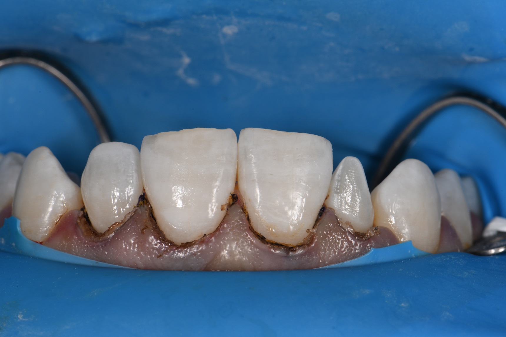 Composite Veneers and Gum Recontouring
