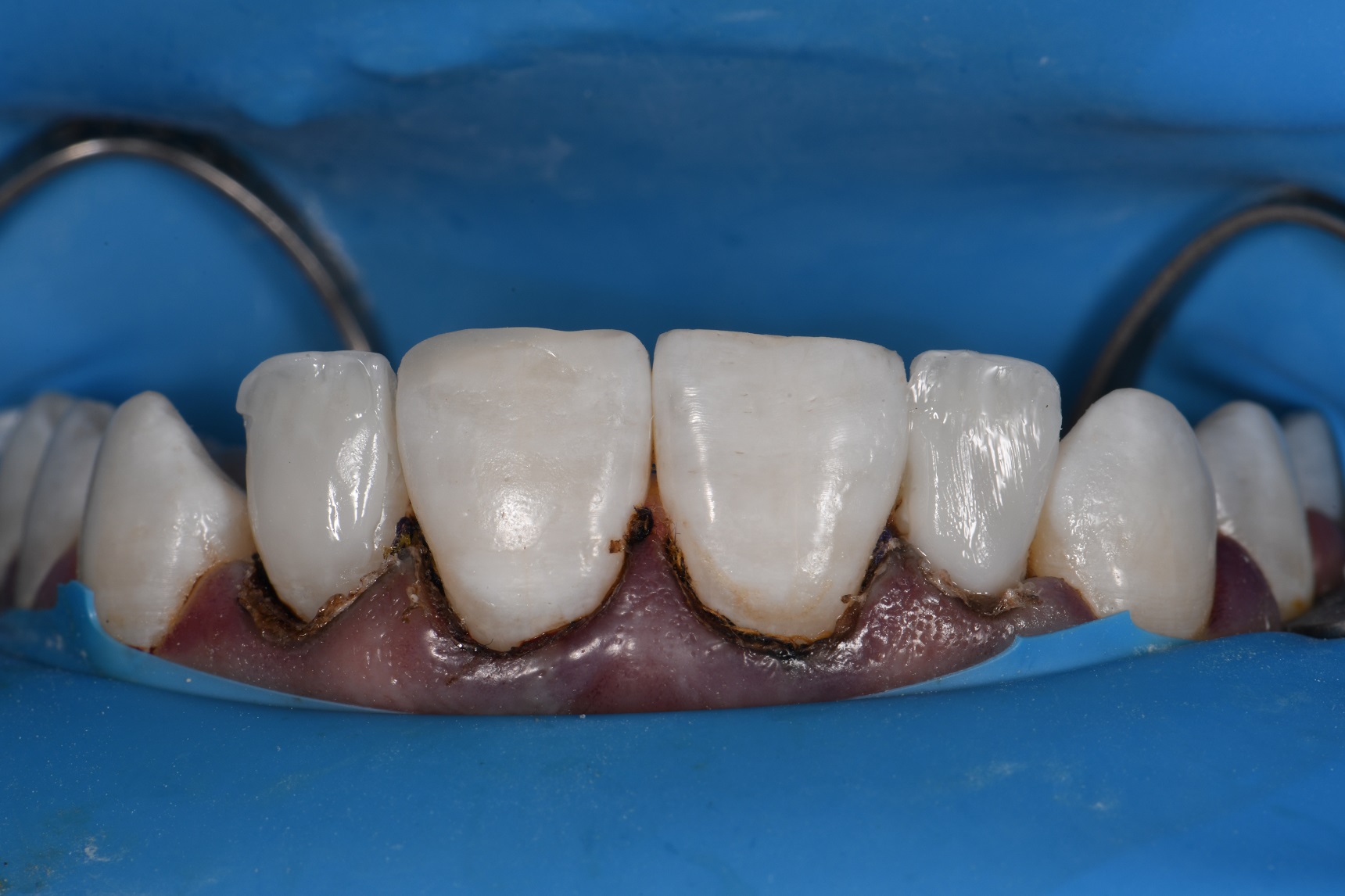 Composite Veneers and Gum Recontouring