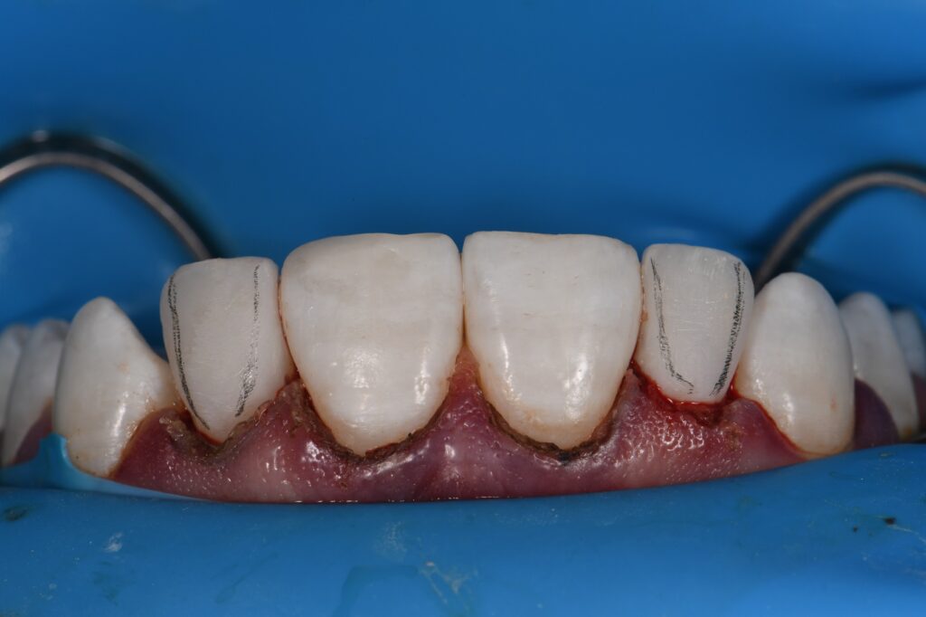 Composite Veneers and Gum Recontouring
