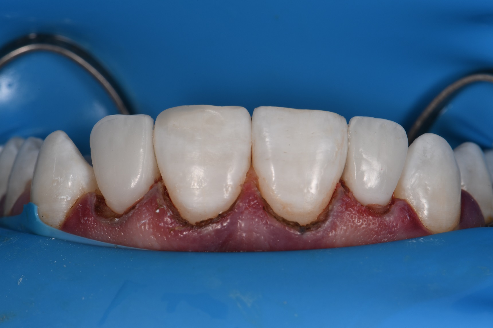 Composite Veneers and Gum Recontouring