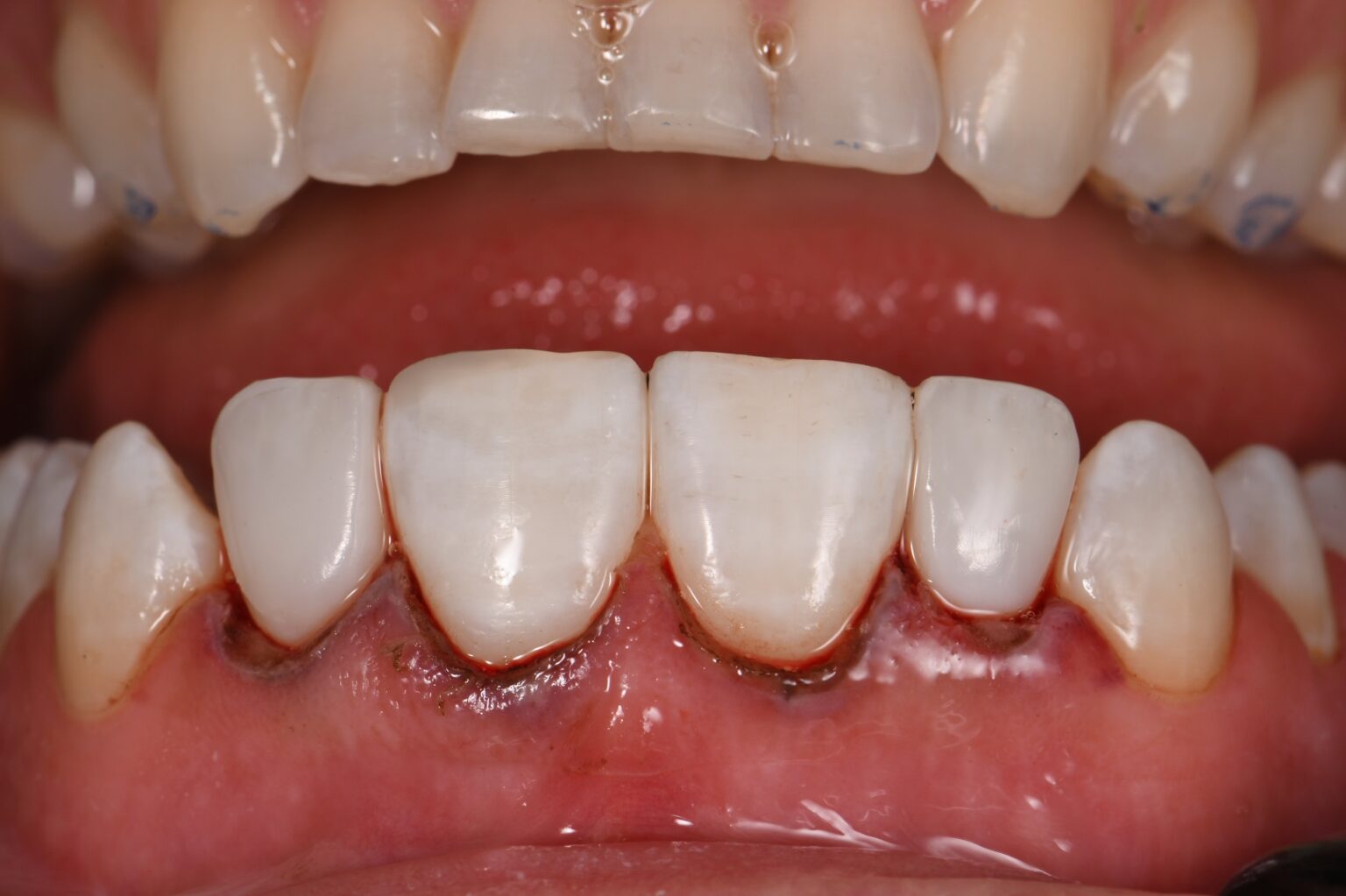 Composite Veneers and Gum Recontouring