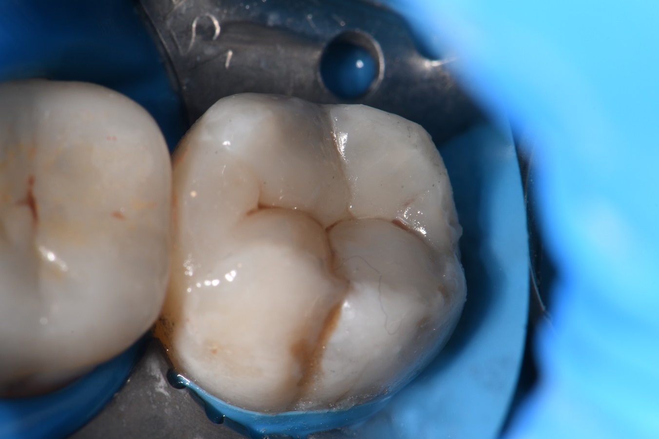 Vertical Hairline Fractures on an amalgam filled wisdom tooth
