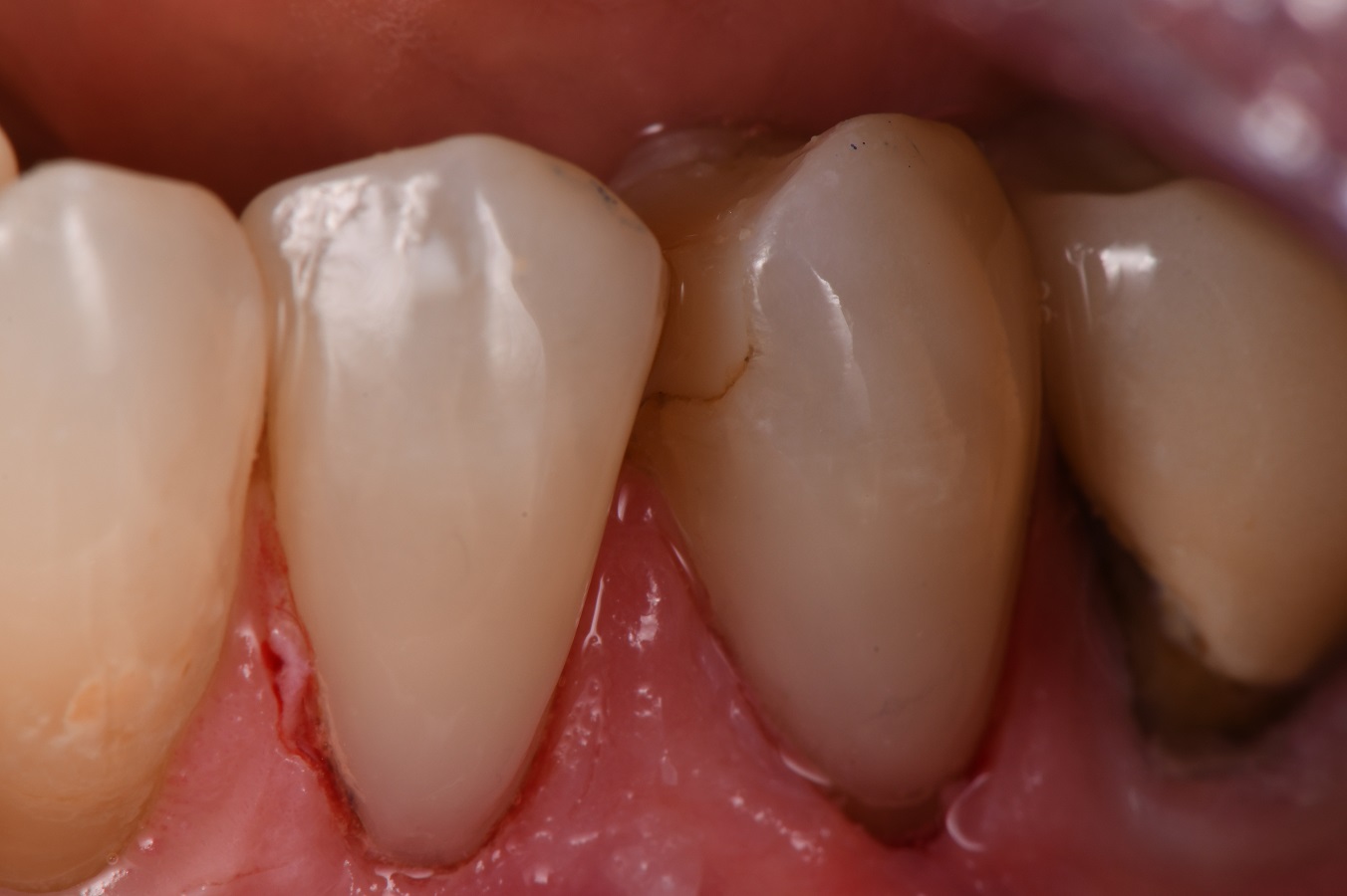 Root Coverage Composite Restorations