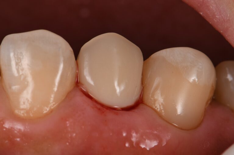 Composite Veneer to Enhance Appearance Deciduous Canine
